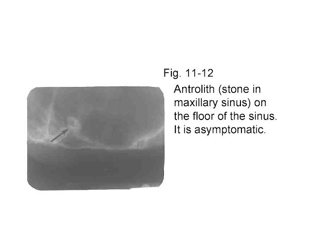 Dentistry and Medicine: SOFT TISSUE CALCIFICATIONS IN ORO-MAXILLO ...