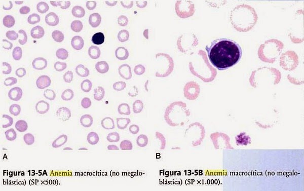 Células importantes en hematología: ANEMIA MACROCÍTICA No megaloblástica