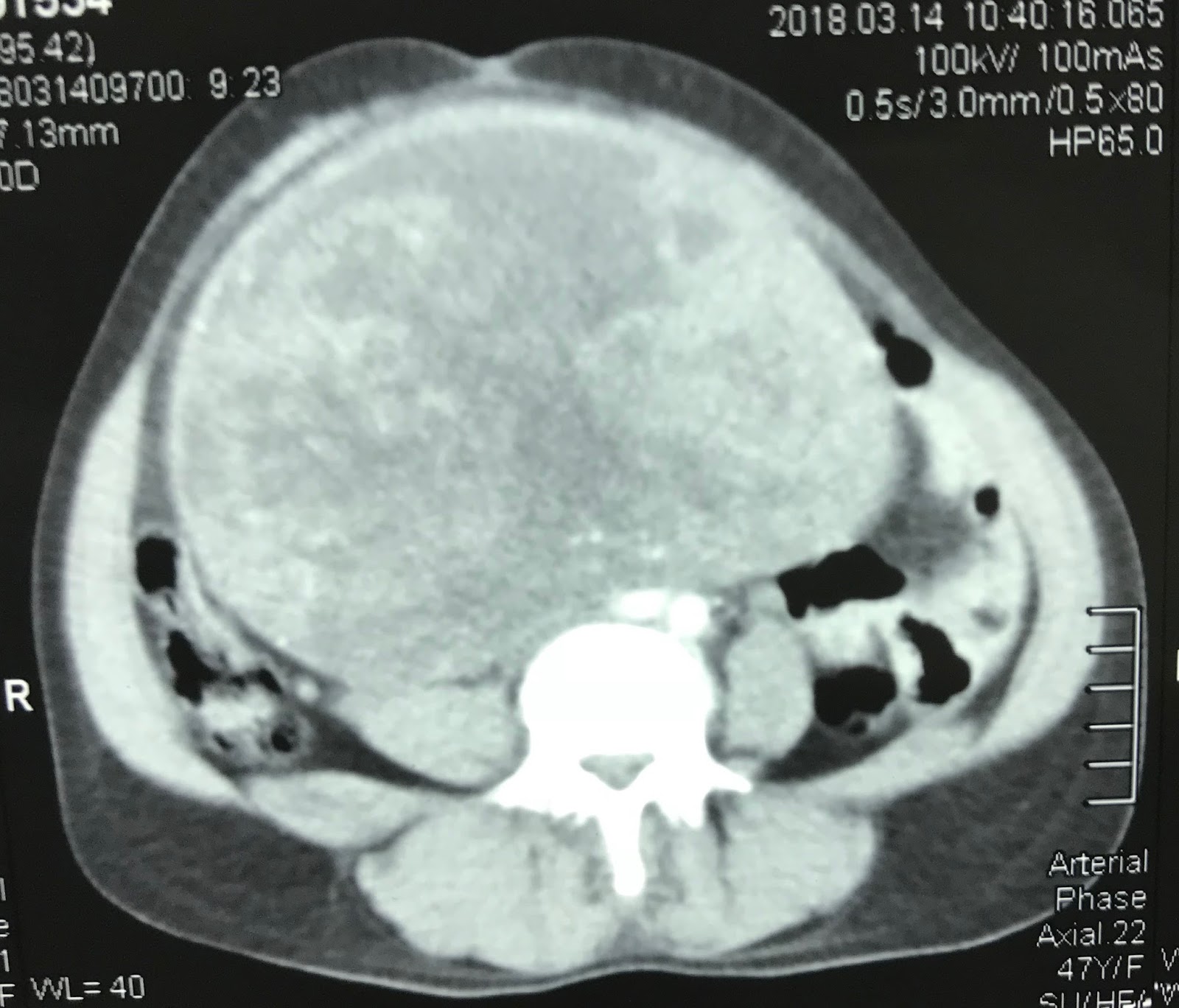 VIETNAMESE MEDIC ULTRASOUND: CASE 483: UTERINE GIANT MYOMA, Dr PHAN ...