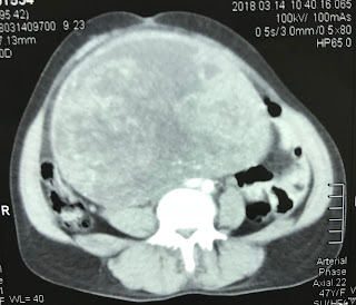 VIETNAMESE MEDIC ULTRASOUND: CASE 483: UTERINE GIANT MYOMA, Dr PHAN ...