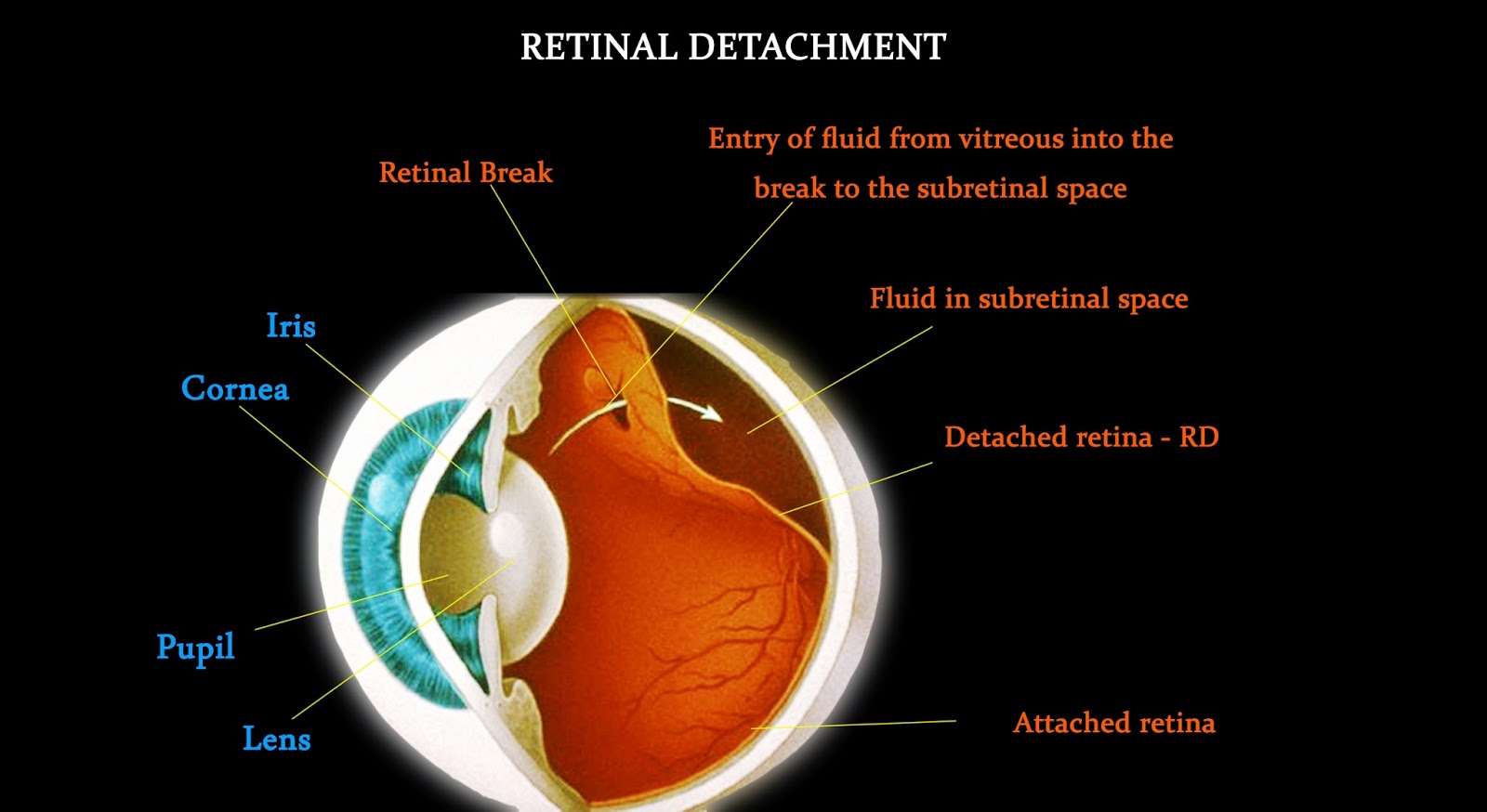 EYE PROBLEMS Myopia Retinal Breaks Retinal Detachment eye-problems-myopia-retinal-breaks-retinal-detachment