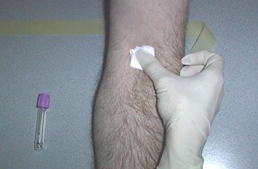 FLEBOTOMIA: Flebotomía