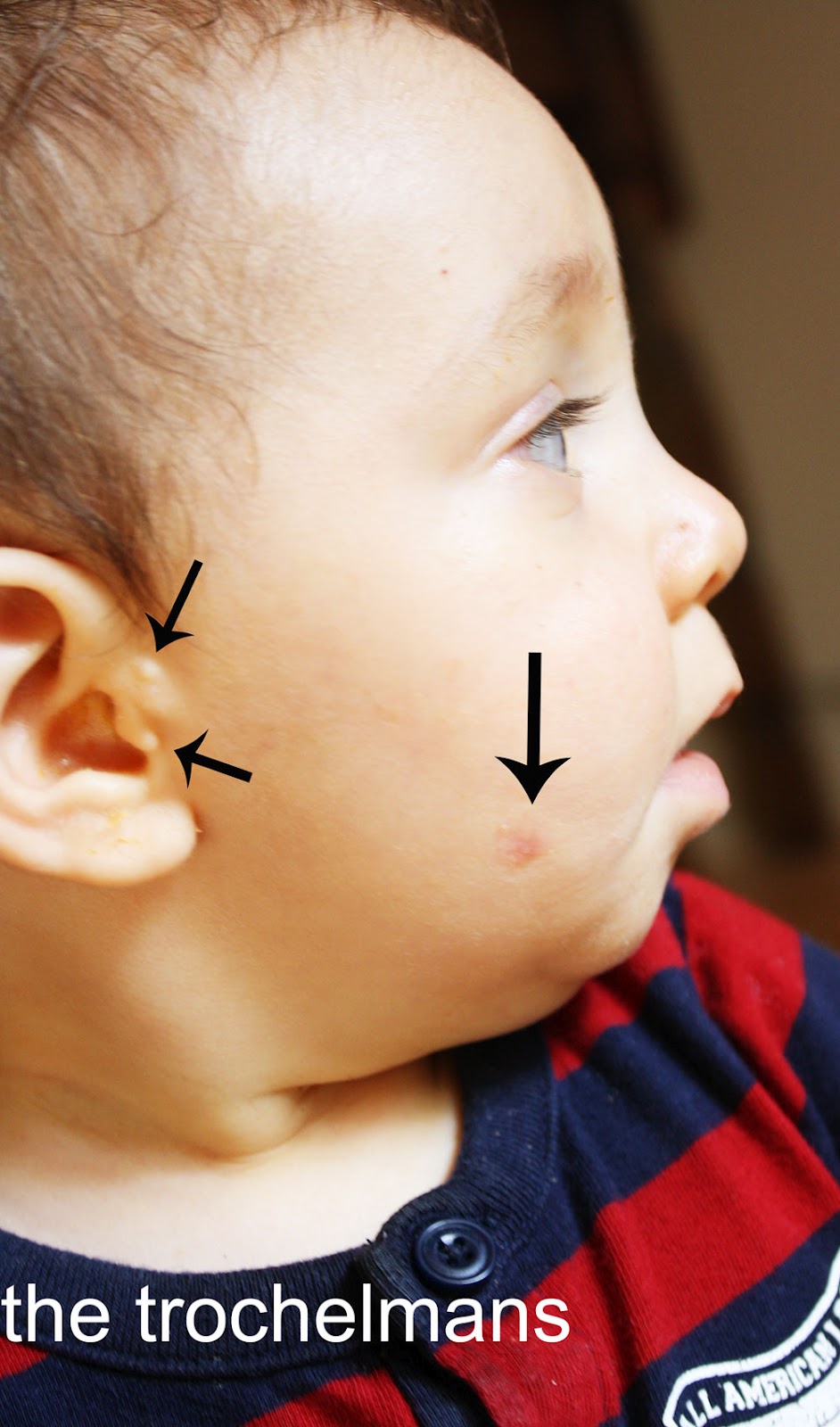 the trochelmans: Skin tag removal on our baby