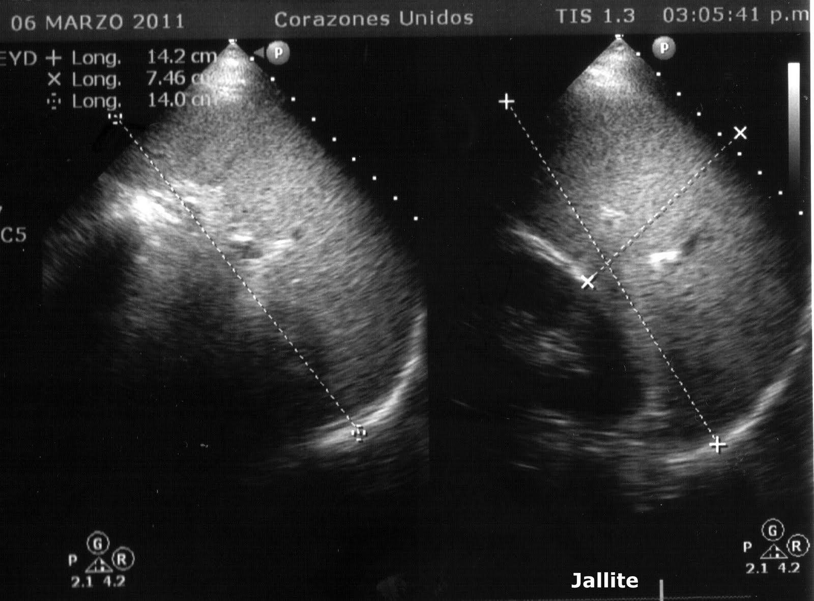 Mononucleosis Infecciosa