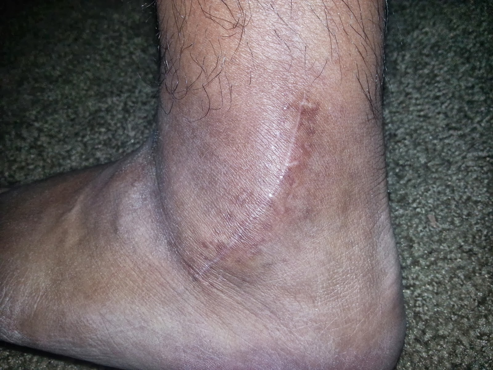 Peroneal Tendon Surgery Recovery: Ankle Time Line (updated for week 10/11)