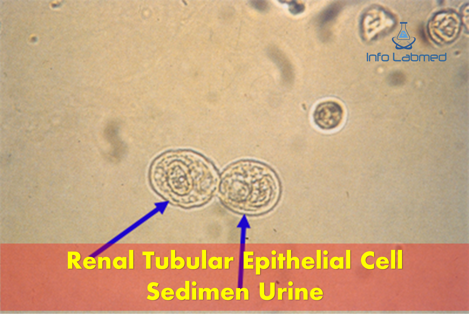 Epithelial Cells In Urine