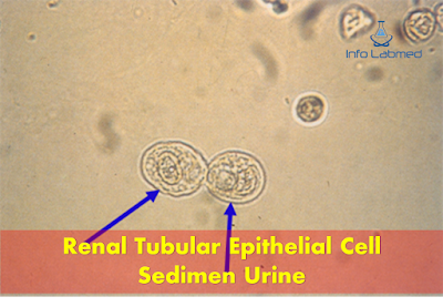 Sel Epithel (Epithelial Cell) Sedimen Urine - Seri Edukasi Teknologi ...
