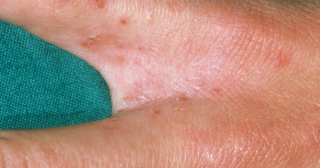 COMMON SKIN RASHES IN DERMATOLOGY PRACTICE