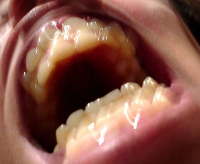 Gum Abscess: Prevention to treatment of abscess in gums