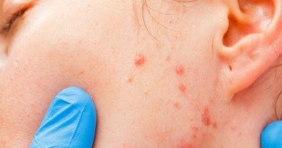 How to get rid of Comedones / Acne?