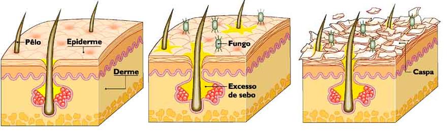 CASPA, EU? RECEITA NATURAL PARA TRATAR CASPA | Clube do cabelo e cia