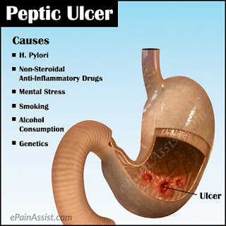 Klinik Medilove Kepong: Helicobacter Pylori / Peptic Ulcer Disease