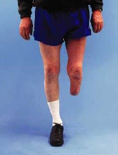 Blogão de Fisio: AMPUTAÇÃO