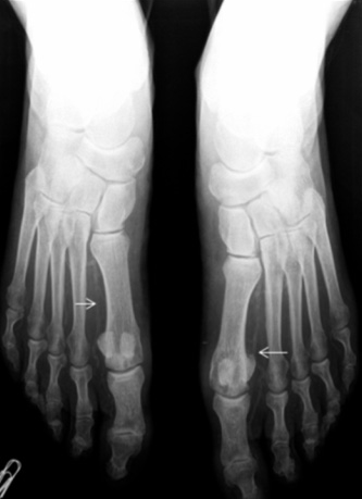 Tecnicos Radiologos: Pie diabético: hallazgos en Diagnóstico por Imagen ...