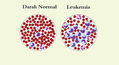 LEUKIMIA | NURHALIMAH.SIREGAR