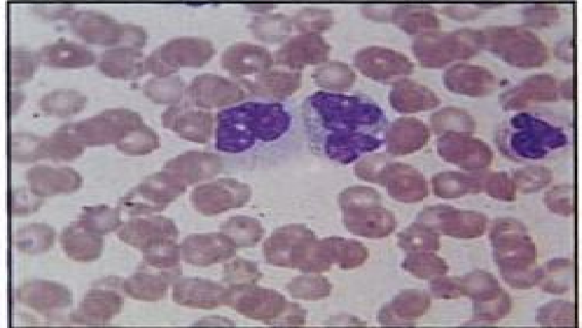 fichero hematologia: Monocitosis