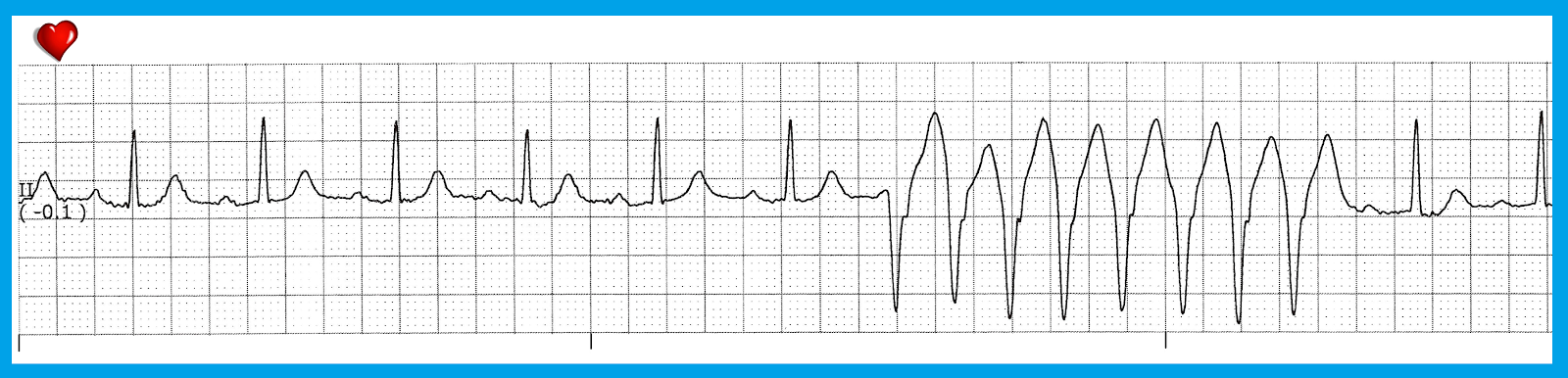 Practice EKG Strips 429