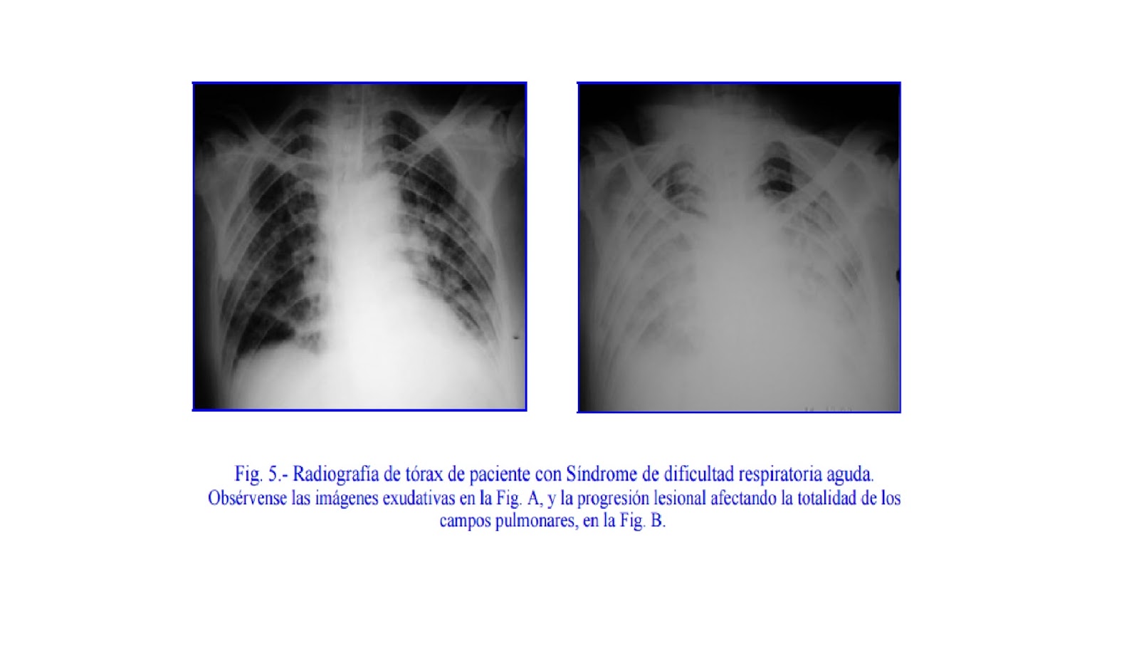 SDRA todo lo que necesitas saber!!: DIAGNÓSTICO
