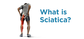 Sciatica treatments: What Is Sciatica?
