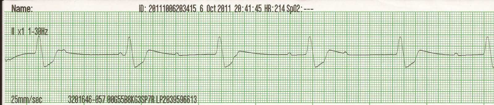 EKG Rhythm Strips 13- Heart Blocks