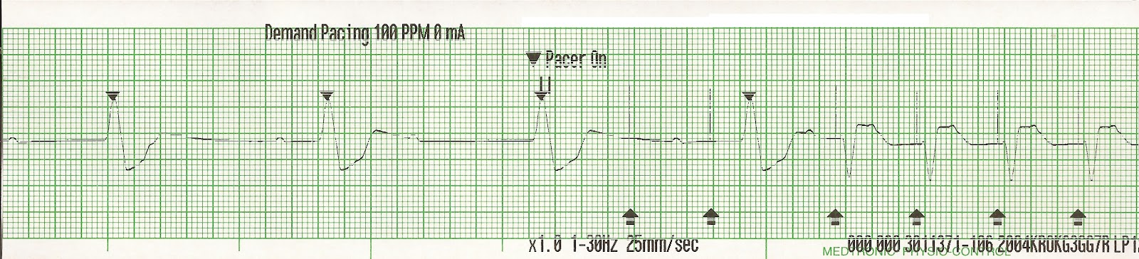 Pediatric External Pacing