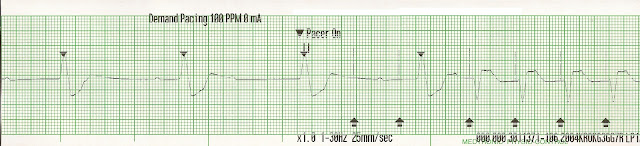 Pediatric External Pacing