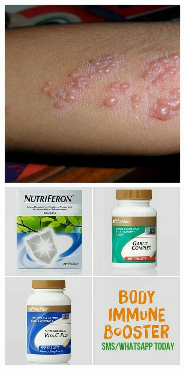 CARA MERAWAT PENYAKIT KAYAP DENGAN CEPAT