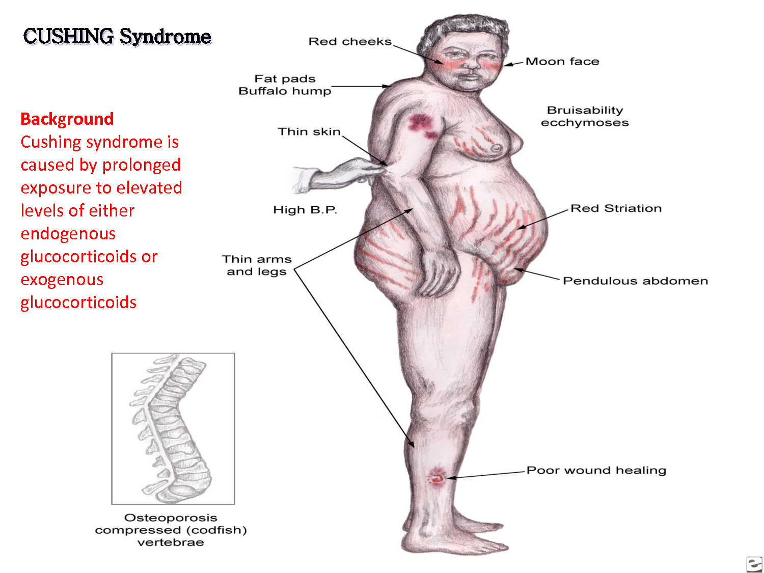 Refleksoloji ve Masaj: KORTİZOL YÜKSEKLİĞİ - CUSHING SENDROMU