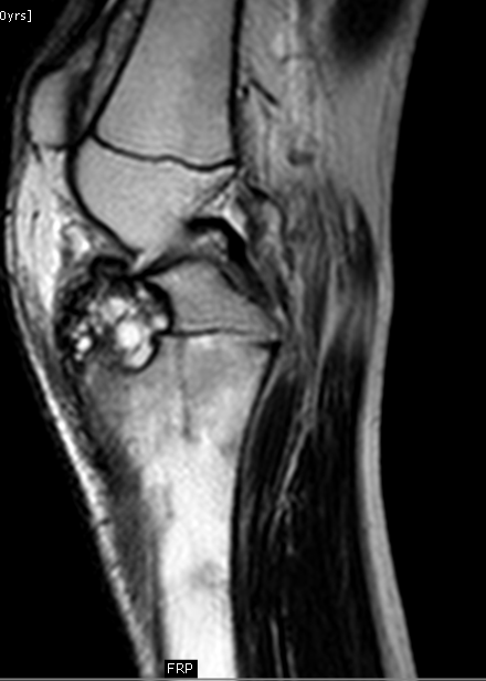 Chondroblastoma-MRI - Sumer's Radiology Blog