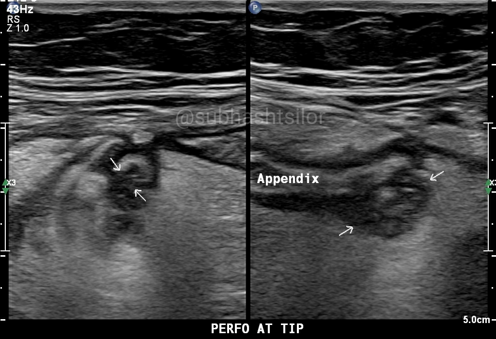 SONO DIGEST: APPENDICITIS WITH PERFORATION AT TIP