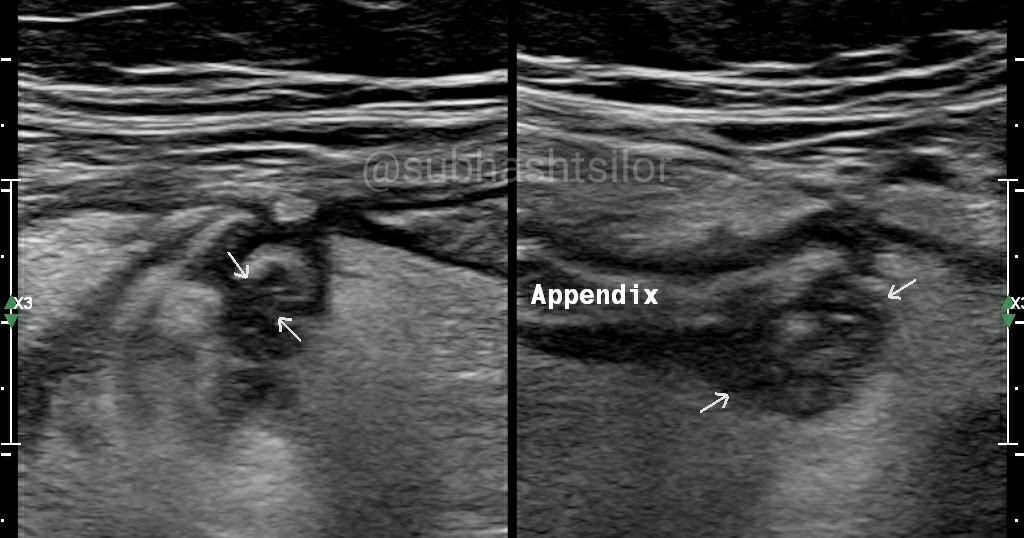 SONO DIGEST: APPENDICITIS WITH PERFORATION AT TIP