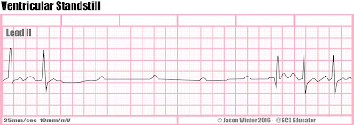 ECG Educator Blog : Six Second ECG Rhythm Strips
