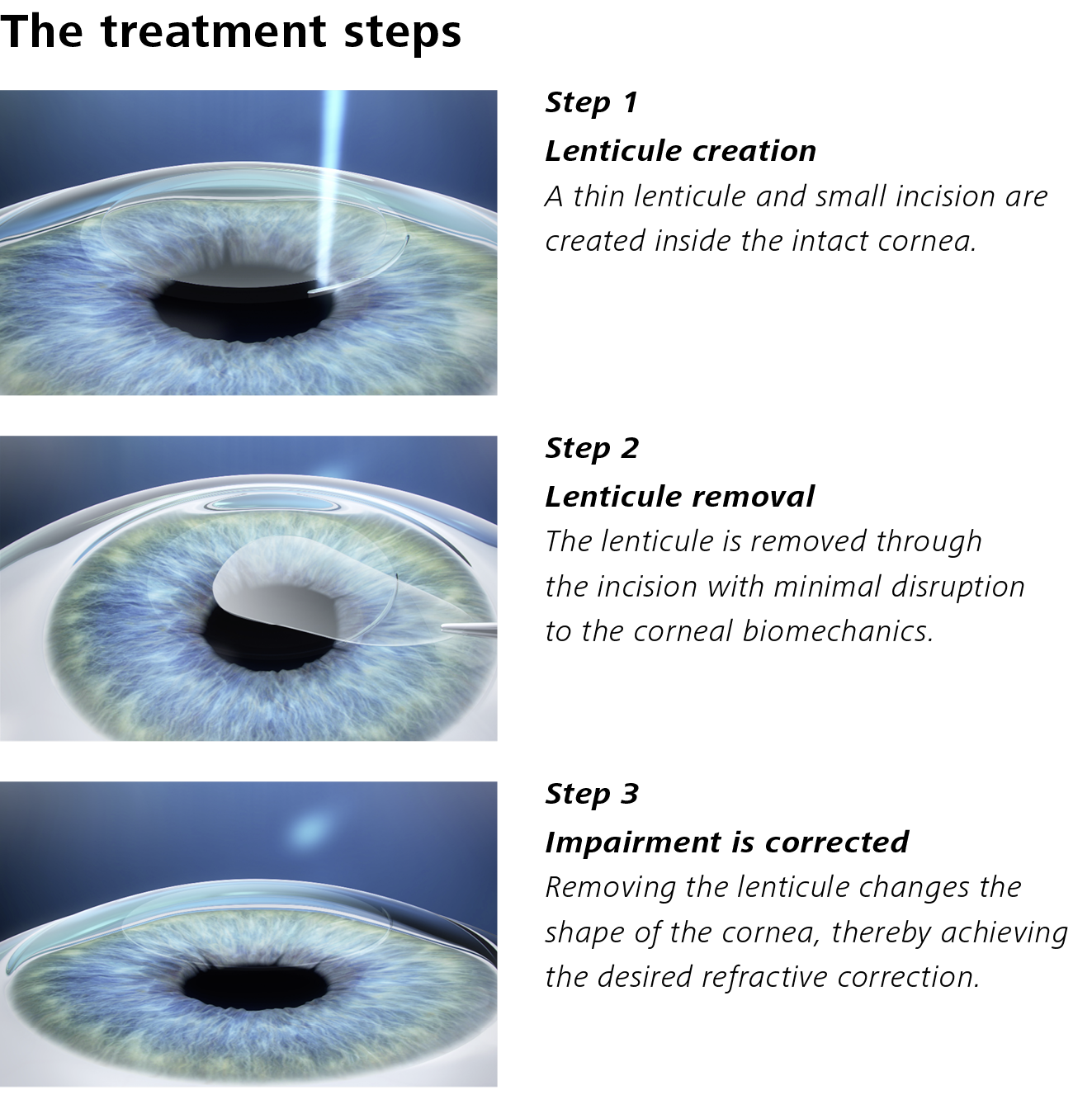 LASIK/LASEK in Seoul, Korea: Relex Smile