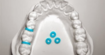 Larissa Explains It All...: Adult Braces: Getting Spacers aka The Prep Work