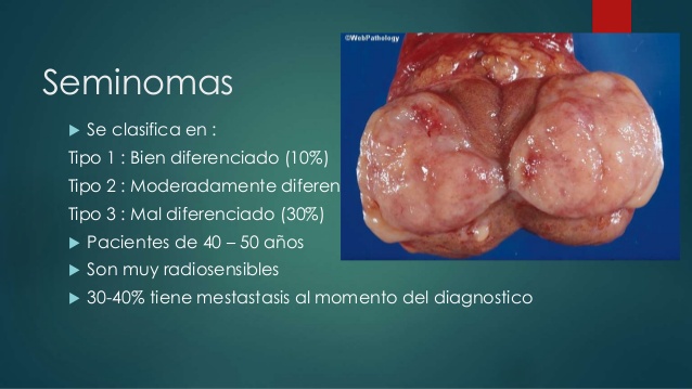 El Calendario Del CÁncer Tipos De CÁncer De TestÍculo