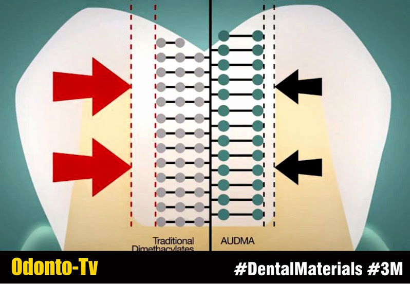 DENTAL MATERIALS: Filtek™ Bulk Fill Posterior utilizes 3M Nanotechnology