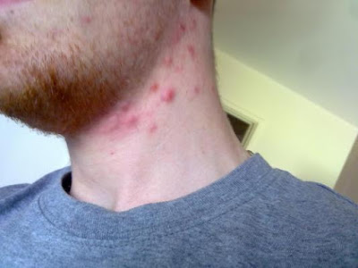 Bad Acne - Causes , Types , Tips and How to cure acne