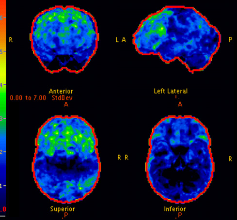 NeuroAnatomía Dr. William Ganem: Parálisis supranuclear progresiva ...