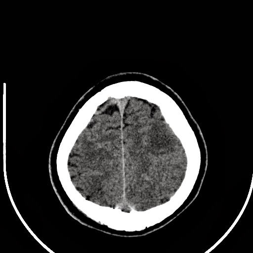 Ultimate Radiology : Bilateral thalamic and cerebellar hypodensity