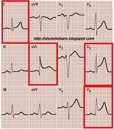ST Elevasi Miokard Infark (STEMI) pada EKG | SholehShare