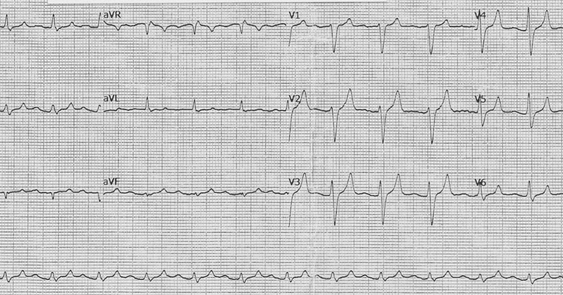 ECG of the Week: ECG of the Week - 29th September 2014 - Interpretation