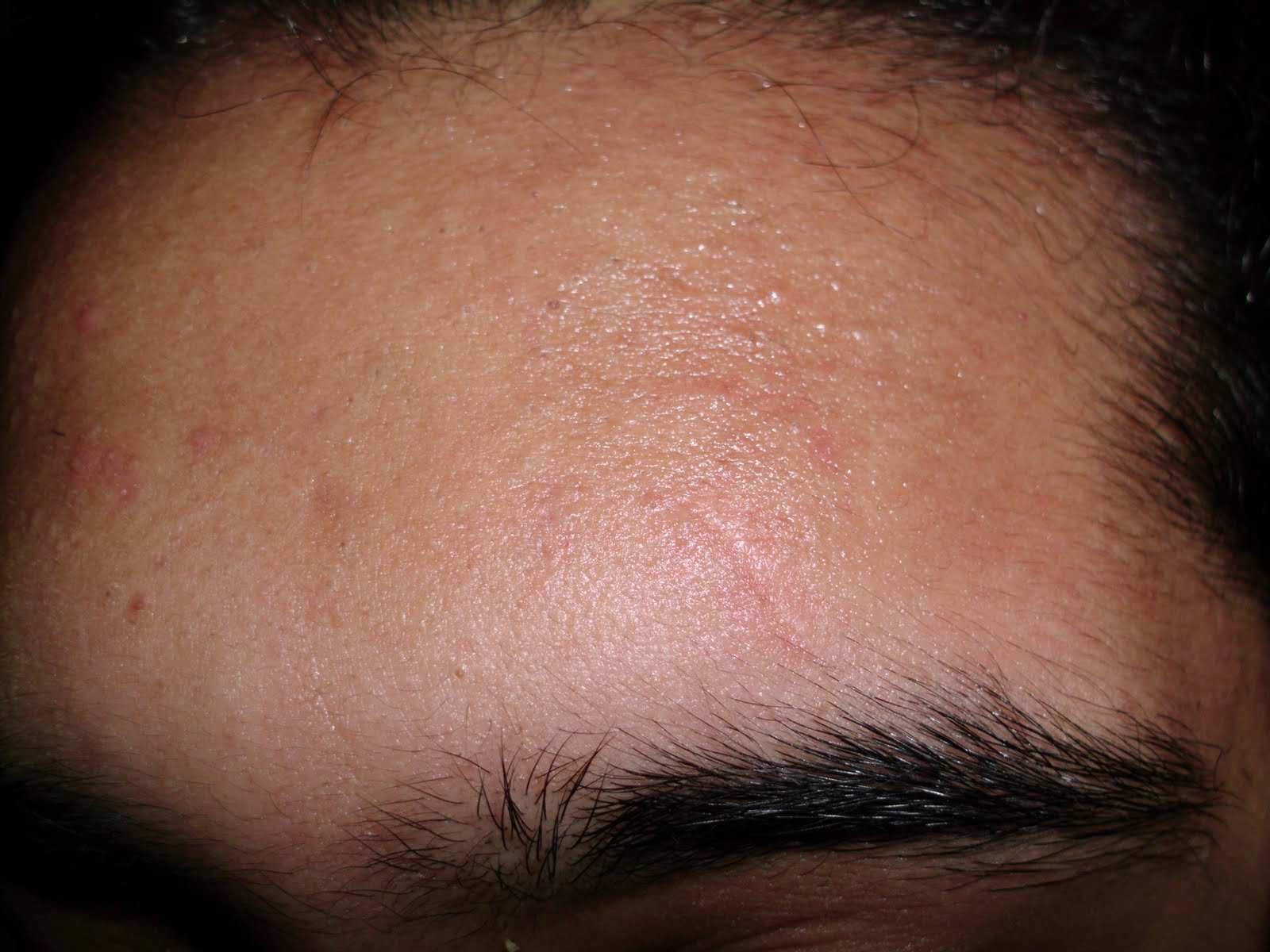 ck3c's: Hole in one's....forehead?