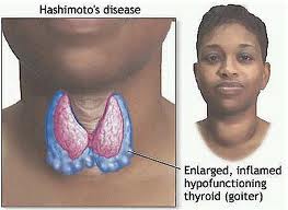 OLLIN TIAR, S.kep, Ners: SNNT (struma nodosa non toksik)