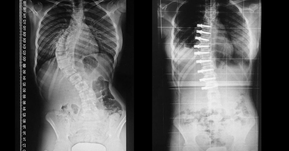 Unha técnica pioneira corrixe a desviación de columna actuando dende o ...