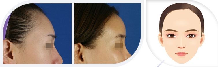 BK Plastic Surgery: [BK Plastic Surgery] Facial contouring: Forehead ...