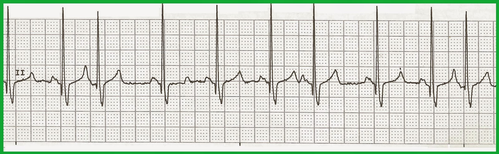 Practice EKG Rhythm Strips 226