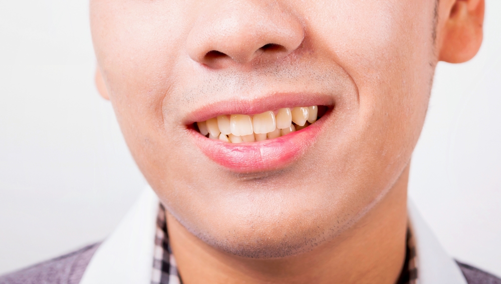 Using Tooth Whitening Methods The Right Way Using Tooth Whitening Methods The Right Way