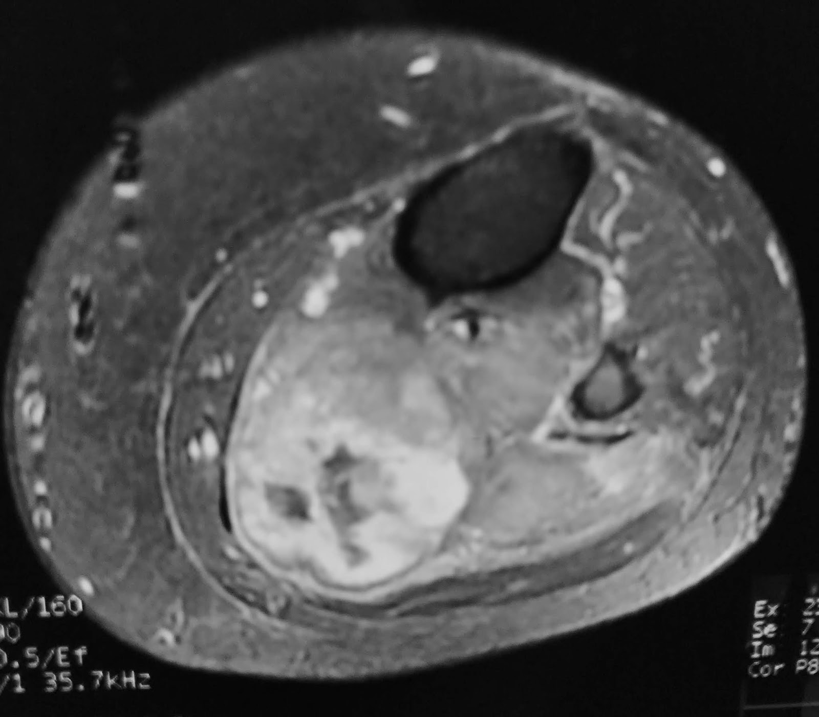 VIETNAMESE MEDIC ULTRASOUND: CASE 523: FIBULAR BONE TUMOR, Dr PHAN ...