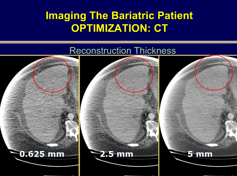 rsna: obesity CT