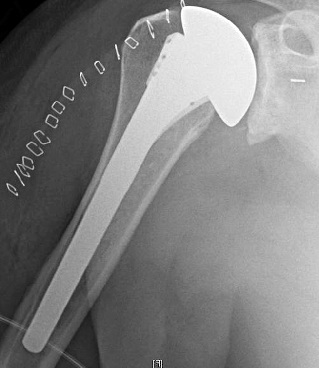 Shoulder Arthritis / Rotator Cuff Tears / Shoulder Pain : Stemless ...